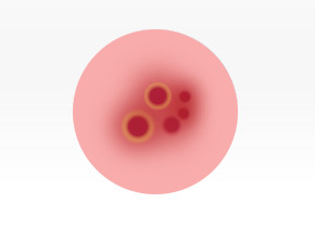 5 Stages of a Cold Sore | What Does a Cold Sore Look Like | Orajel