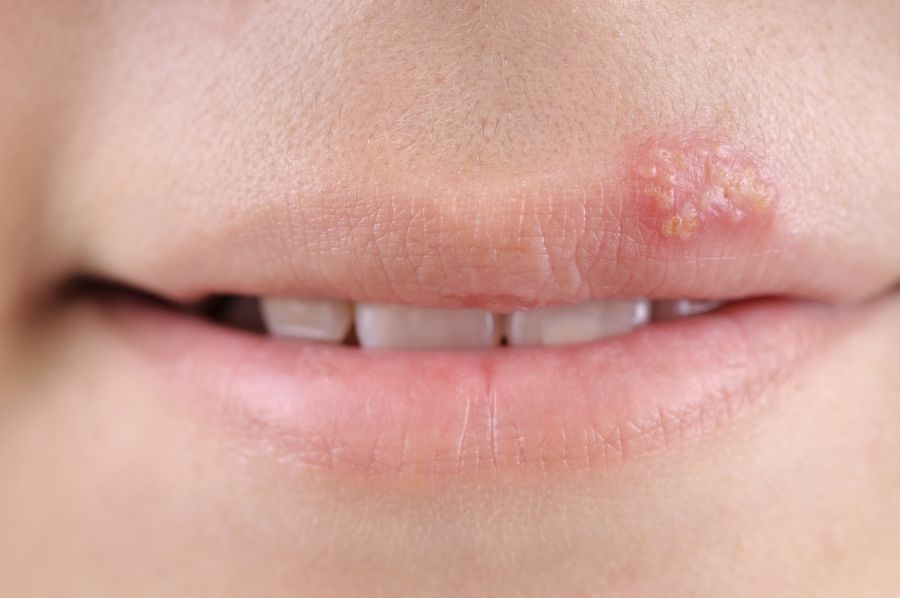 Cold Sores Illustration Different Stages Cold Sores Inflammation Stock Cold Sores Illustration Different Stages Cold Sores Inflammation Stock